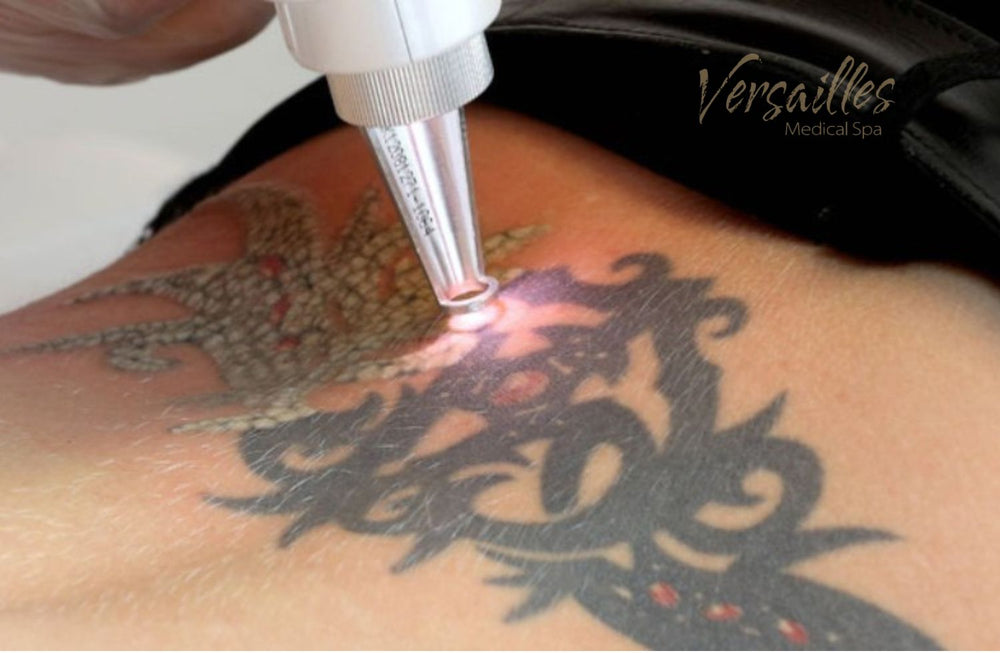 Laser Tattoo Removal | Versailles Medical Spa